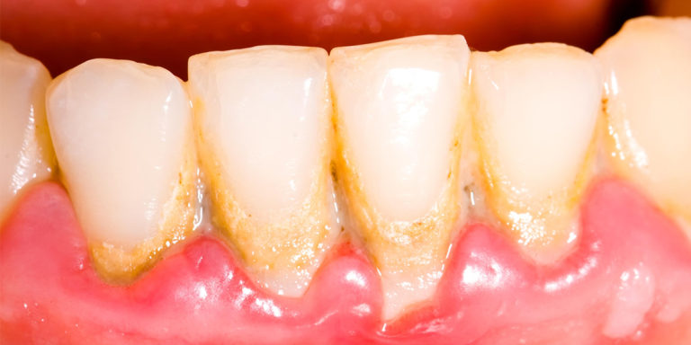 4 Best Ways To Prevent Plaque Build Up